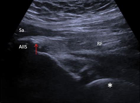 The Straight Head Of Rectus Femoris An Underdiagnosed Cause Of Chronic