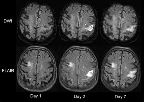 Complete Early Reversal Of Diffusion Weighted Imaging Hyperintensities
