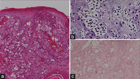 Disseminated Cryptococcosis Indian Journal Of Dermatology