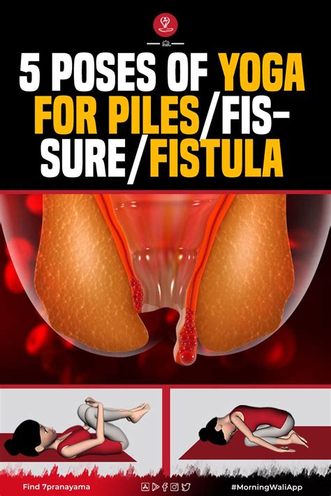 Effective Yoga For Piles Fissures Reduce Symptoms Of Hemorrhoids Artofit