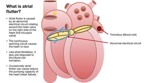 Atrial Flutter Ablation Bayside Heart