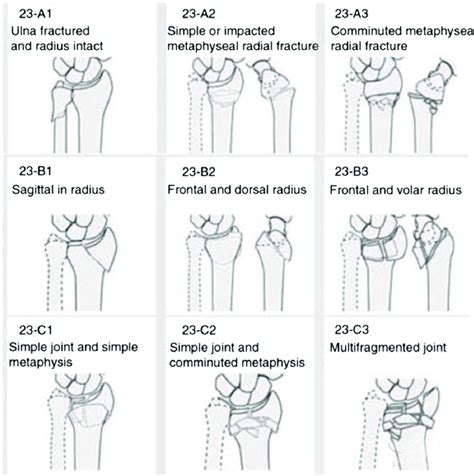 Intraobserver Reliability Of The Ao Classification Us