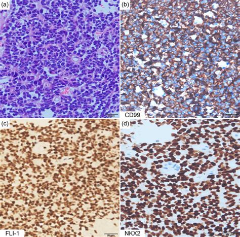 Pathological Examination Of The Tumor A Hematoxylin And Eosin