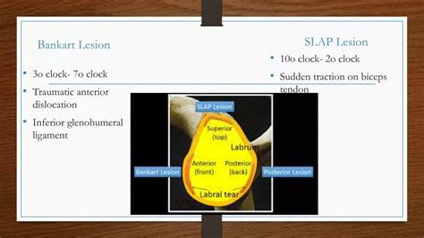 Special Test For Labrum Tear Pptx