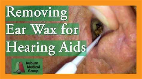 Removing Ear Wax For Hearing Aids Earwaxremoval Auburn Medical Group
