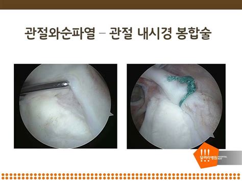 관절와순파열 회전근개파열 운동선수에서 수술치료의 결과 달려라병원 어깨전문의 박재범 YouTube