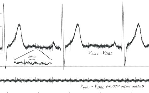 11 A Pseudo Differential Ecg Recording Made With The Download Scientific Diagram
