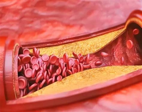 血管堵塞严重的人，晚上睡觉可能有这6种迹象，最好去查一下脑ct 知乎