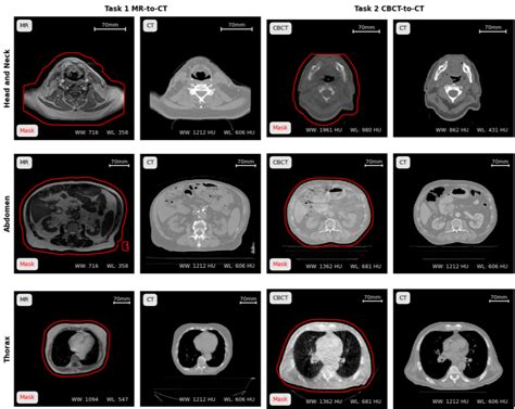 论文审查 Synthrad2025 Grand Challenge Dataset Generating Synthetic Cts For Radiotherapy
