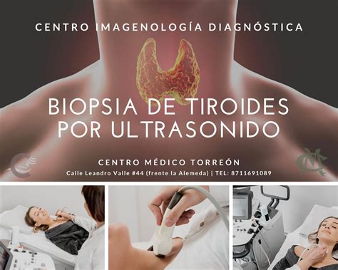 🔎 Biopsia De Tiroides Centro Imagenología Diagnóstica