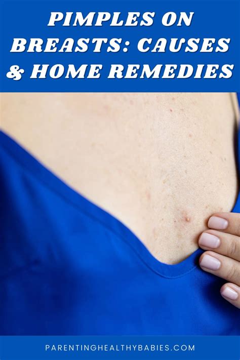 Best 12 Pimples On Breasts Causes And Home Remedies Artofit