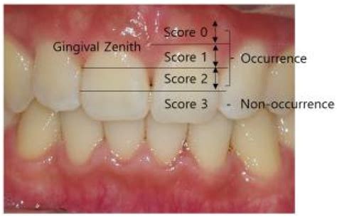The Occurrence And Risk Factors Of Black Triangles Between Central