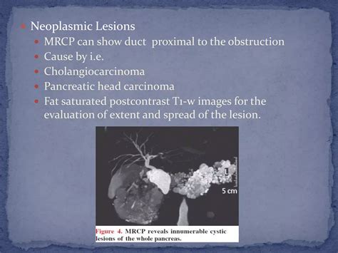 Magnetic Resonance Cholangiopancreatography Mrcp Pptx