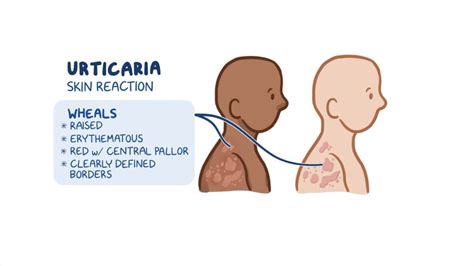 Important Nursing Considerations For Urticaria Ask The Nurse Expert