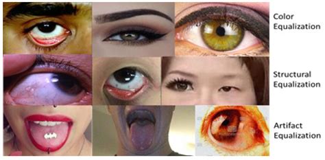 Iron Deficiency Anemia Eyes