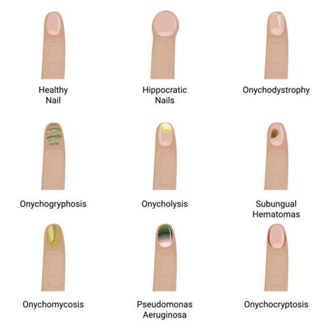 170 Onycholysis Stock Illustrations Royalty Free Vector Graphics