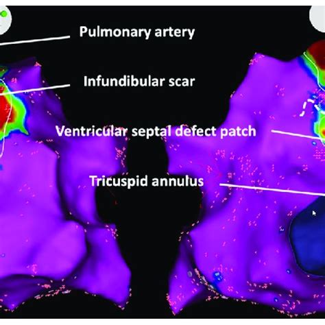 Critical Isthmus Between Ventricular Septal Defect Patch And Pulmonary