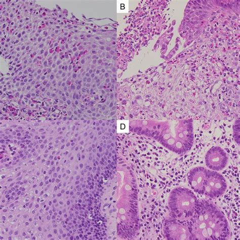 Pathological Findings Of The Biopsy Tissue Of Esophagus And Duodenum Download Scientific