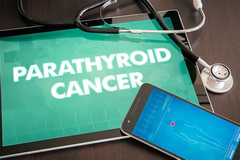 Cáncer De Paratiroides Todo Lo Que Debes Saber