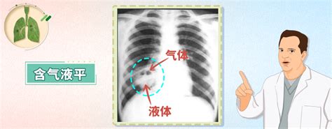 影像检查发现肺部有阴影是肺癌吗 阴影 组织 肺部 影像 检查 健康界