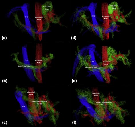 Low Venc Postcontrast Flow Visualization Examples For Workflow 1 Ac