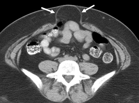 Abdominal Ct Findings Contrast Enhanced Ct Showed That My XXX Hot Girl