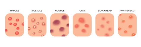 Premium Vector Acne Types Facial Infections Pimples And Skin