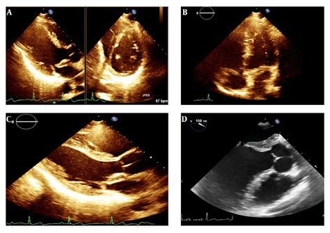 Figure 2 From Congenital Hypoplastic Mitral Valve Annulus An Incidental Finding In A 30 Year