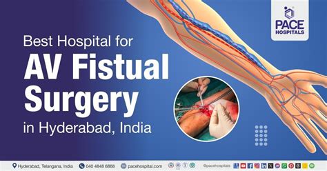 Best Av Fistula Surgery In Hyderabad For Dialysis Types And Cost