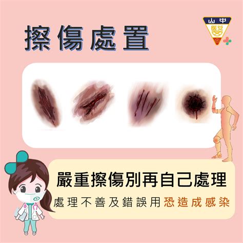 擦傷處置 怡安職護殿堂