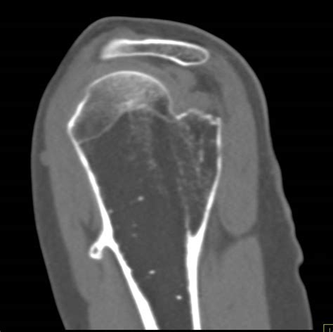 Deformed Humerus With Multiple Exostosis Musculoskeletal Radiology