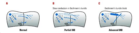 Atrial Activation In A Healthy Subjects B With Partial Interatrial