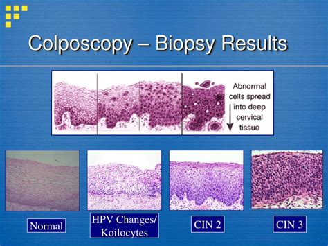 Understanding Cervical Biopsy Results Eoxpnu