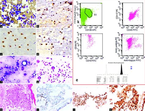 Cytosmear Showing Singly Scattered Atypical Plasma Cells With