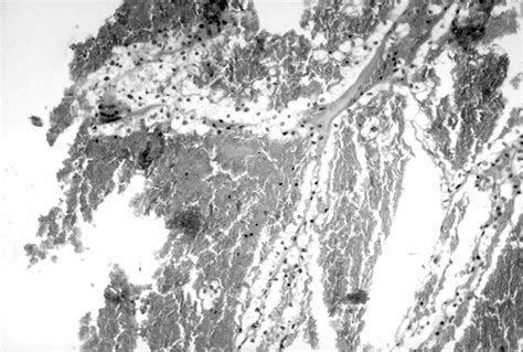 Renal Oncocytoma With A Novel Chromosomal Rearrangement Der 13 T 13 16