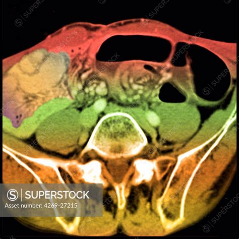 Intestinal Obstruction Color Enhanced Axial Computed Tomography Ct