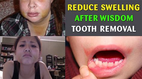 How Long Does Swelling Go Down After Wisdom Teeth Removal At Ana Brady Blog