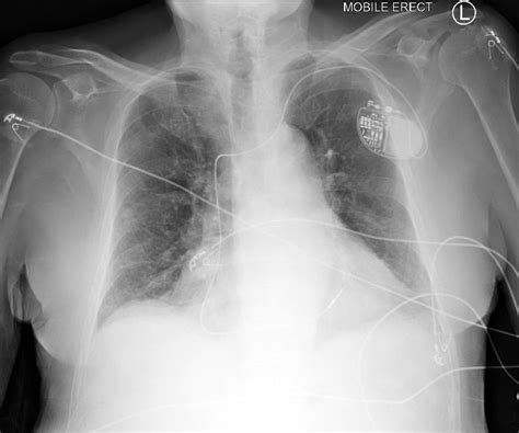 Noncardiogenic Pulmonary Edema Cxr