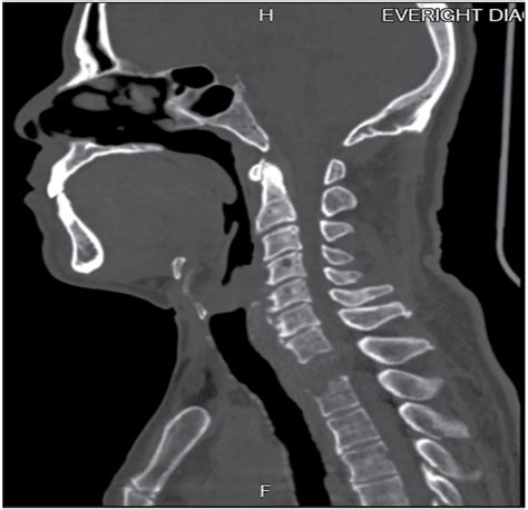 Median Sternotomy As A Useful Adjunct To Anterior Cervicotho