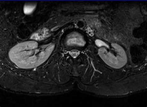 Plan L Plexus Stir Axi Mrimaster
