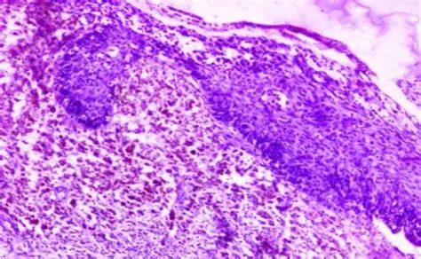 Figure 3 From Microinvasive Squamous Cell Carcinoma Of Uterine Cervix