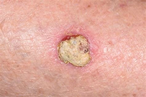 Bowenoid Keratosis Stock Image C0564405 Science Photo Library