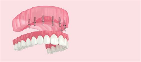 A Partially Analog Approach By Dr Emil M Verban Jr Dentaltown