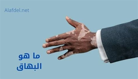 ما هو البهاق؟ وما هي أنواعه وأعراضه وطرق علاجه