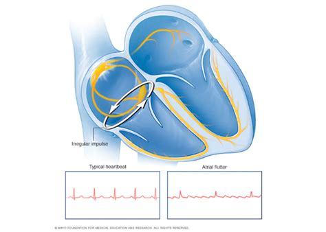 Atrial Flutter Ablation At Drkarthigesan Clinic Chennai