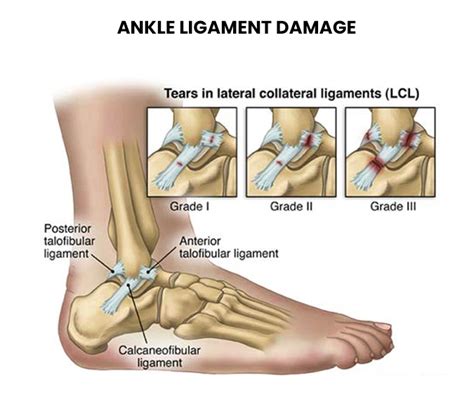 Torn Ligament On Top Of Foot Recovery Factory Sale