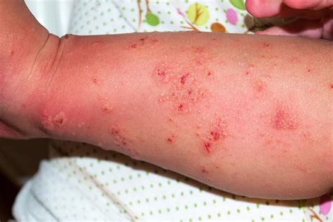 Scabies Rash On Hands