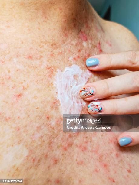 Scratch Marks On Face