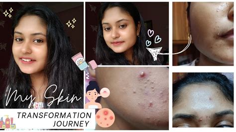 My Skin Transformation Journeyhow I Reduce My Hormonal Acnehow To
