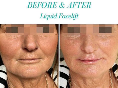Before After Liquid Facelift Photo Facelift Info Prices Photos Reviews Q A